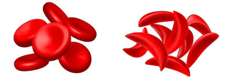 Sickle Cell Disease - DR SILKY JAIN